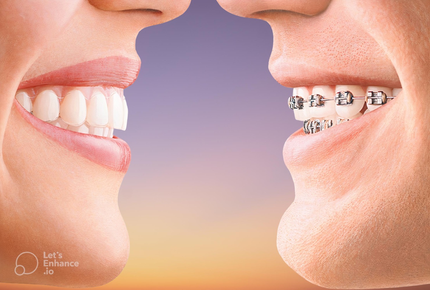 4 Things To Know About Invisalign Retainers